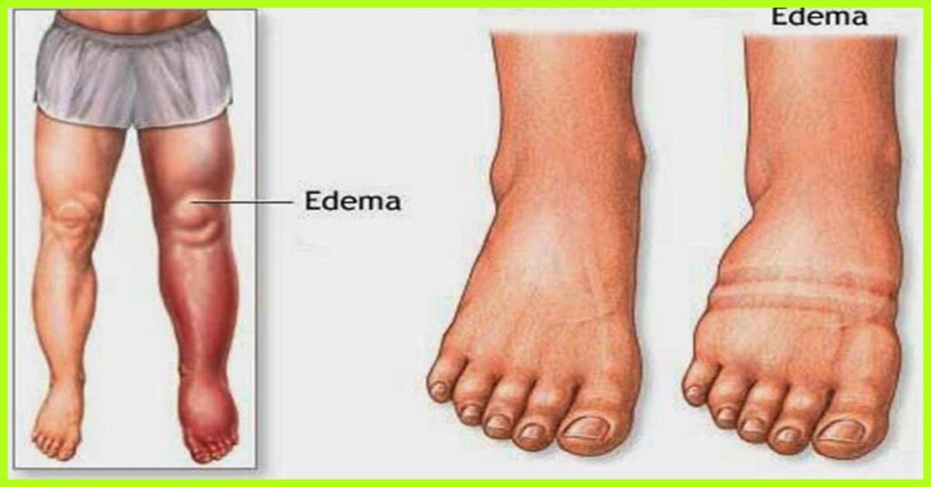 Edema and Its Types - Overall Science
